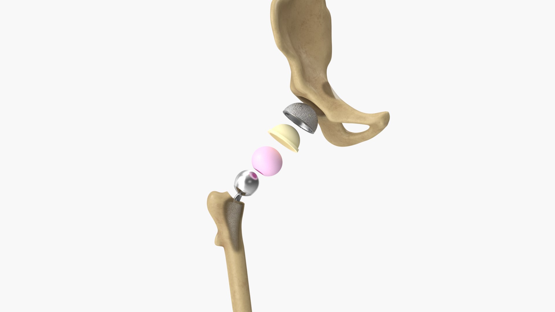 Hip Bone Replacement Surgery V02 3D Model - TurboSquid 1744809