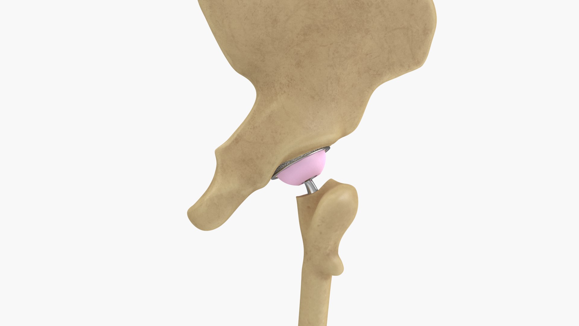 Hip Bone Replacement Surgery V02 3D Model - TurboSquid 1744809