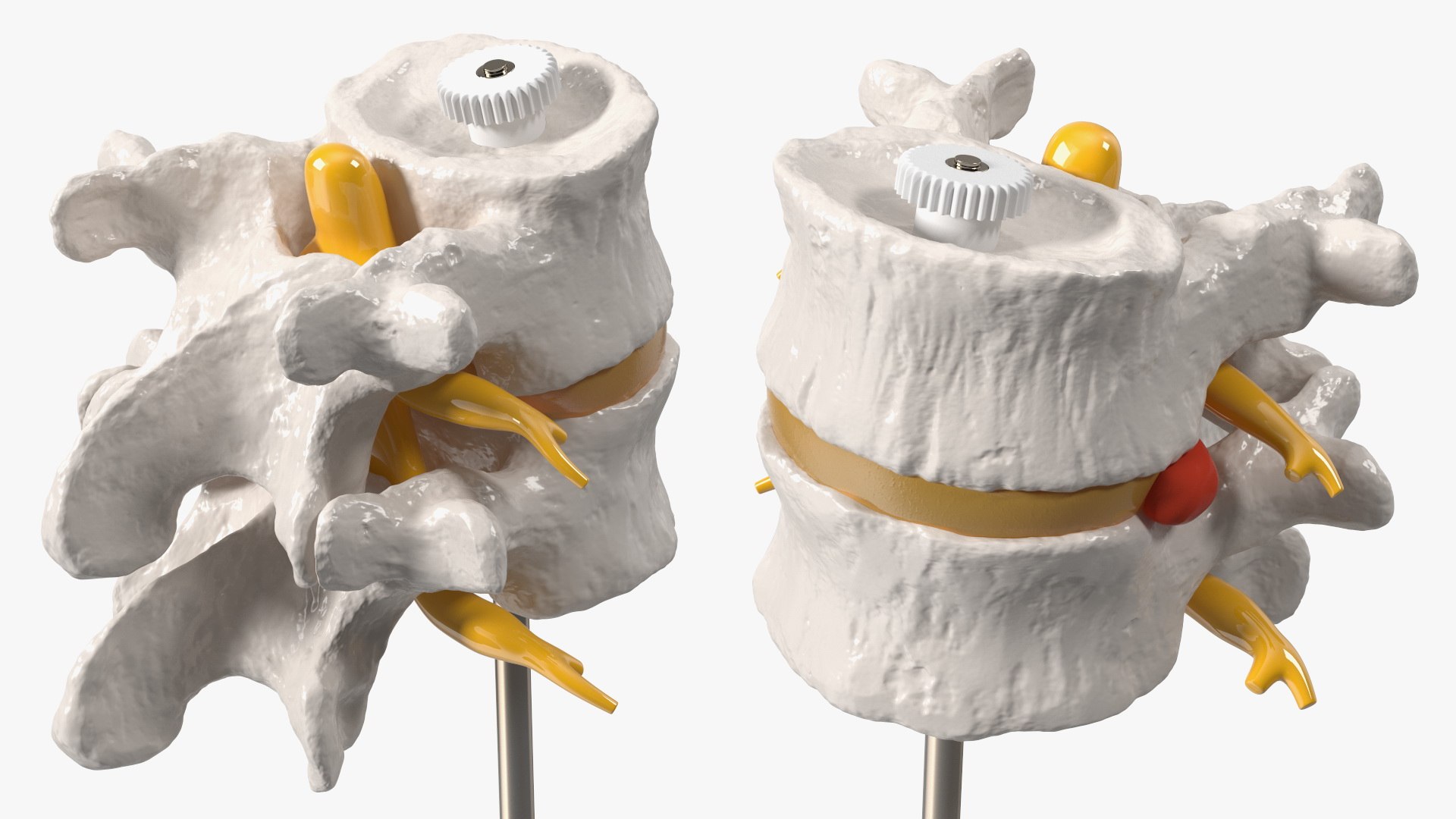 3D Stand With Herniated Spinal Vertebrae Model - TurboSquid 2051054