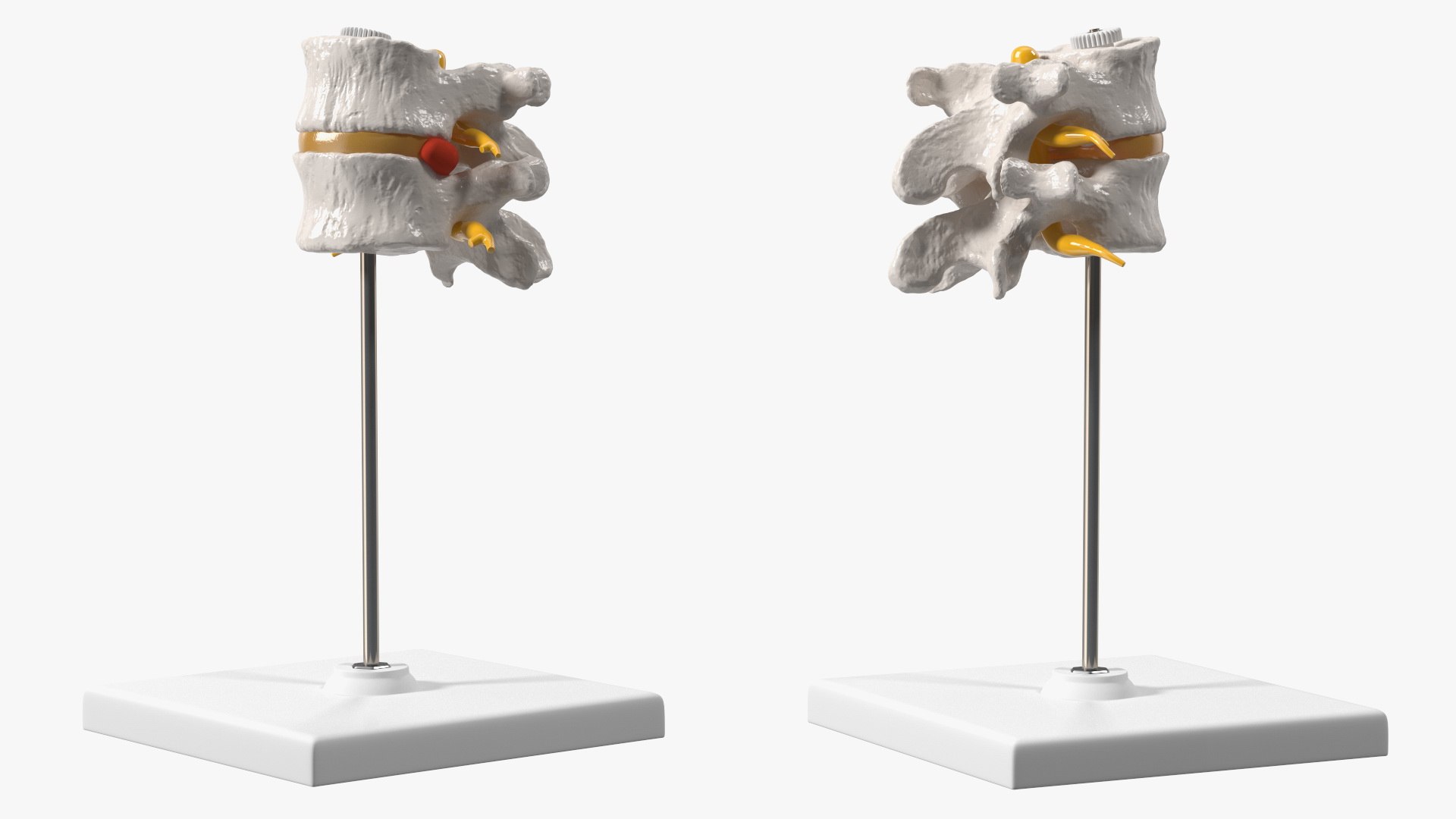 3D Stand With Herniated Spinal Vertebrae Model - TurboSquid 2051054