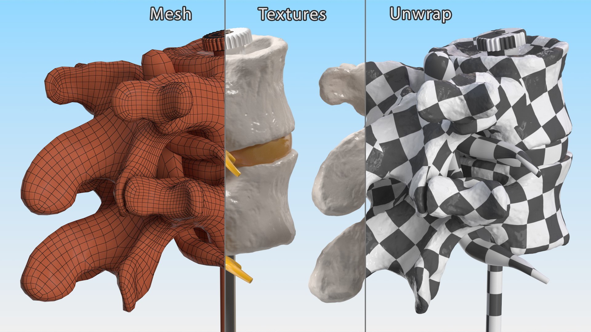 3D Stand With Herniated Spinal Vertebrae Model - TurboSquid 2051054