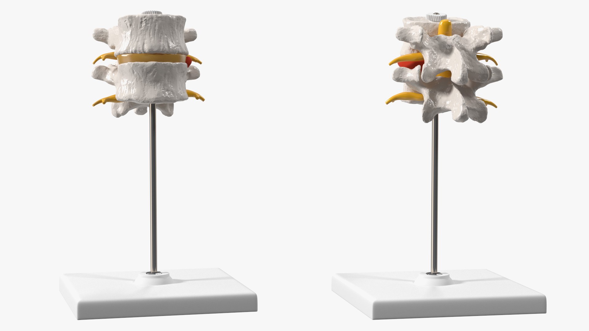 3D Stand With Herniated Spinal Vertebrae Model - TurboSquid 2051054