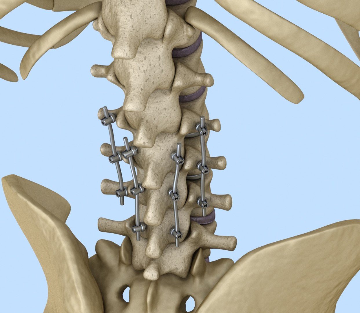 3D Model Spinal Fixation - Titanium - TurboSquid 1231782