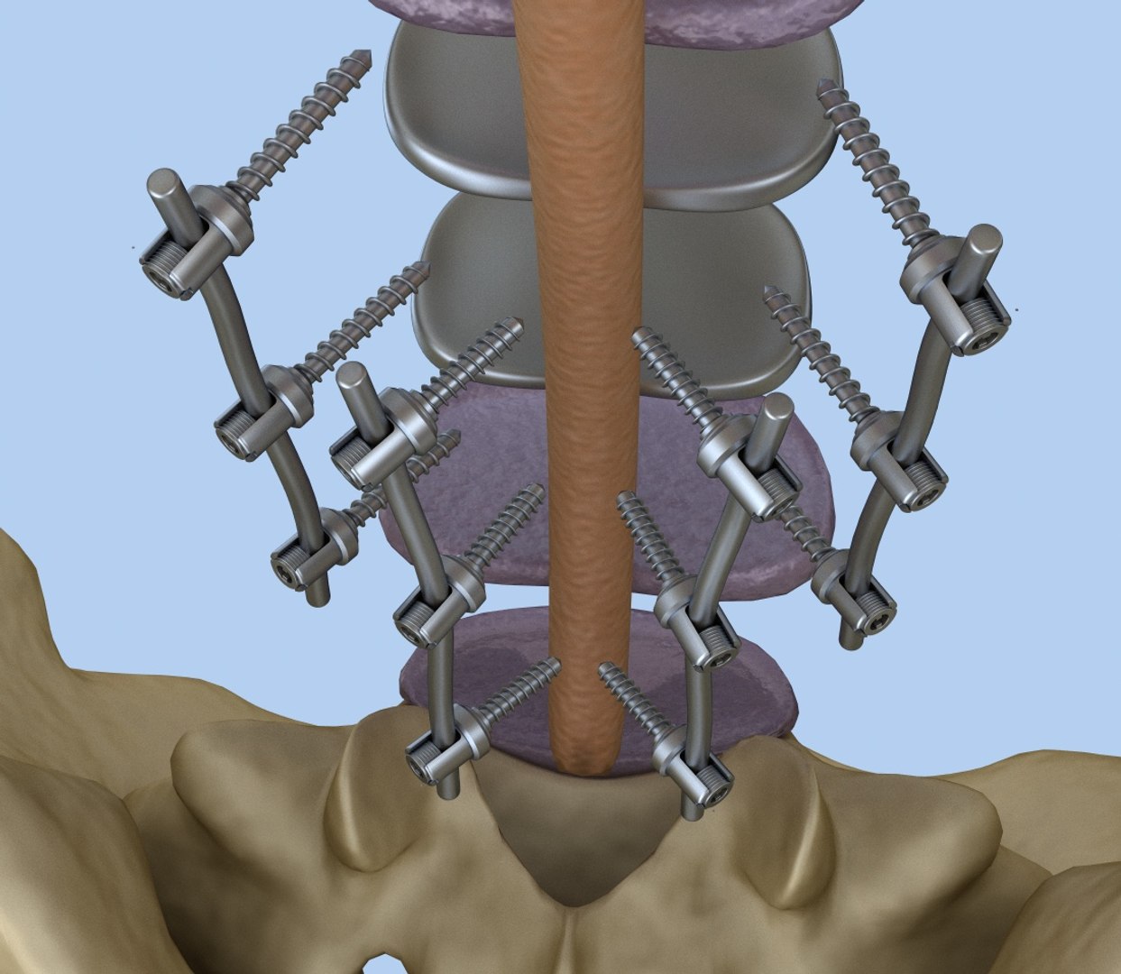3D Model Spinal Fixation - Titanium - TurboSquid 1231782