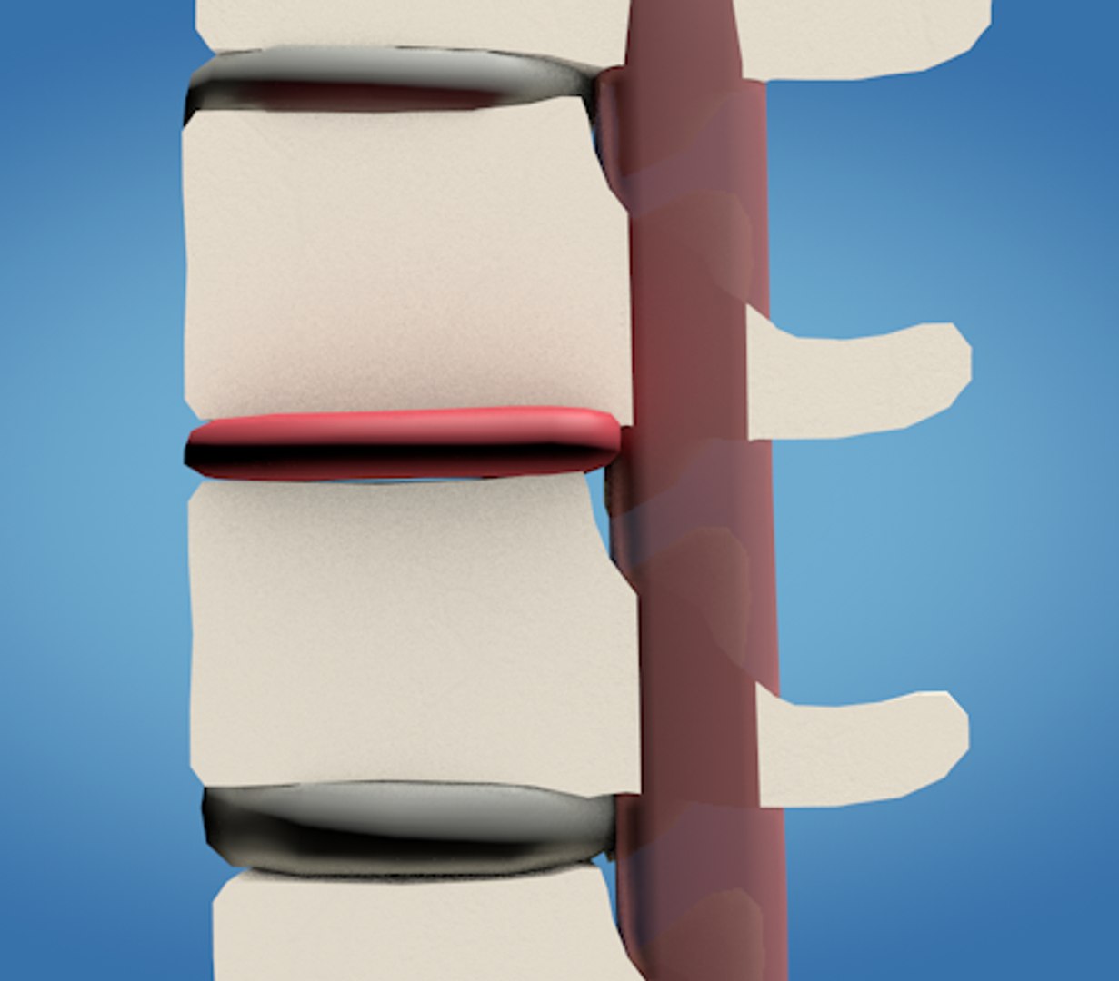 Spine Compression Model - TurboSquid 1196478
