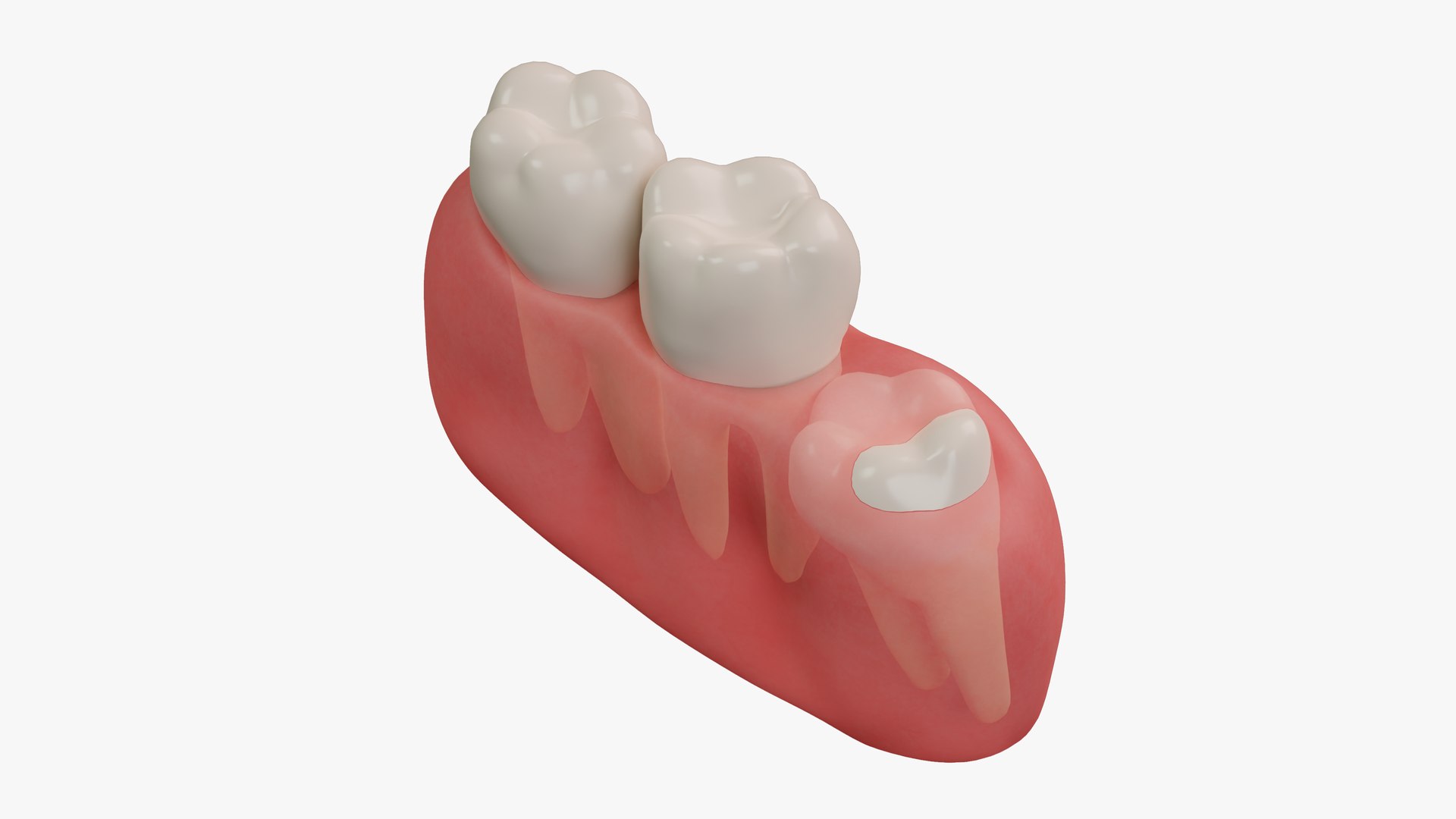 3D Model Impacted Wisdom Teeth - TurboSquid 1866134