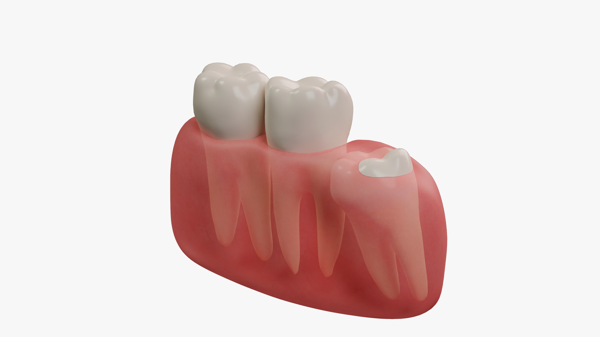 3D Model Impacted Wisdom Teeth - TurboSquid 1866134