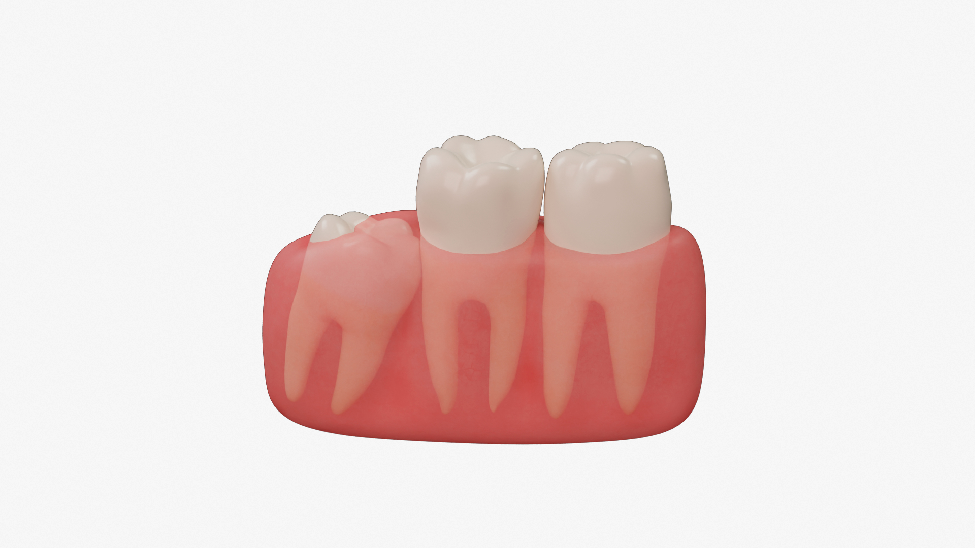 3D Model Impacted Wisdom Teeth - TurboSquid 1866134