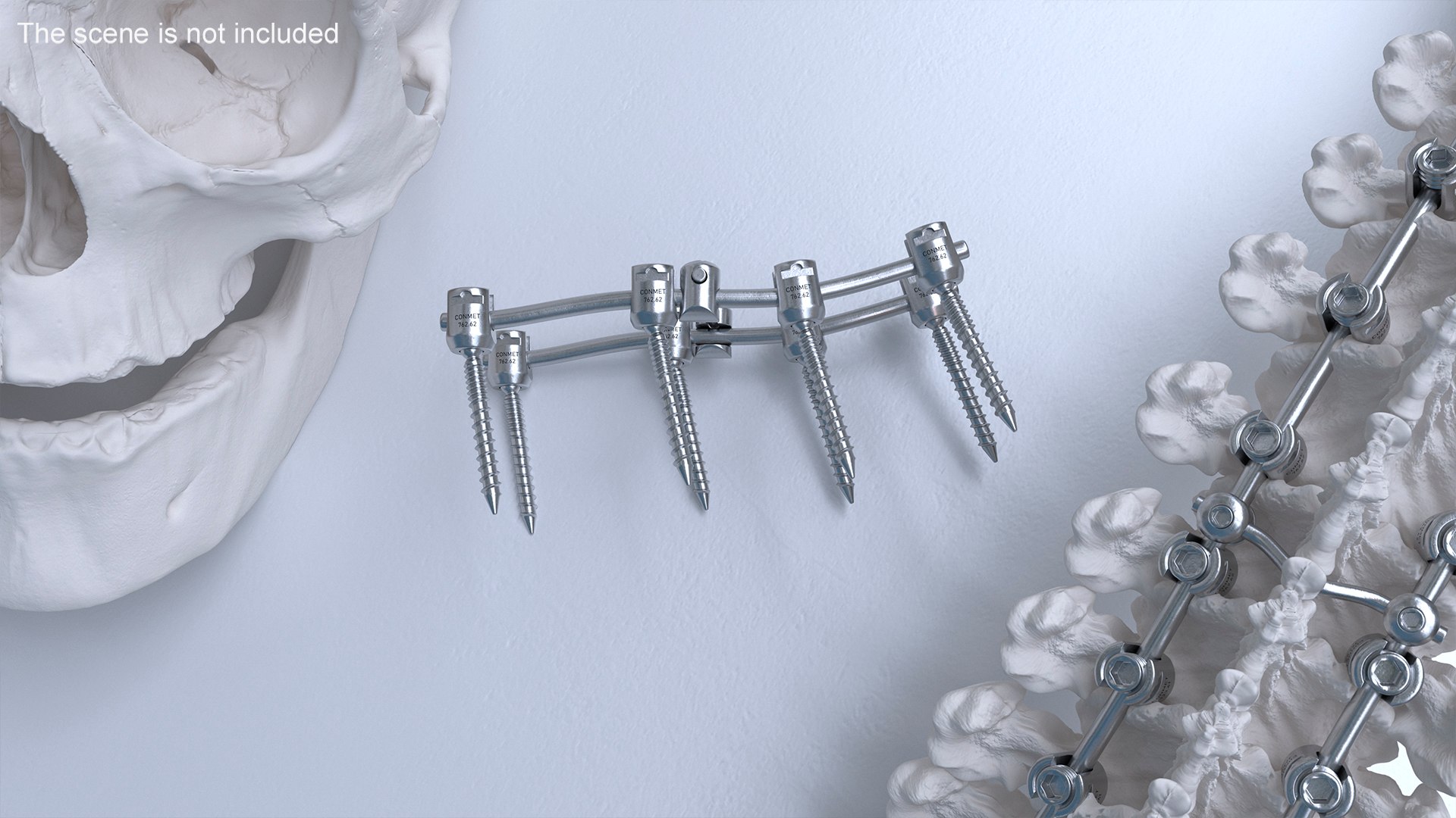 3D Lumbar Cervical Spine Fixation System - TurboSquid 2205813