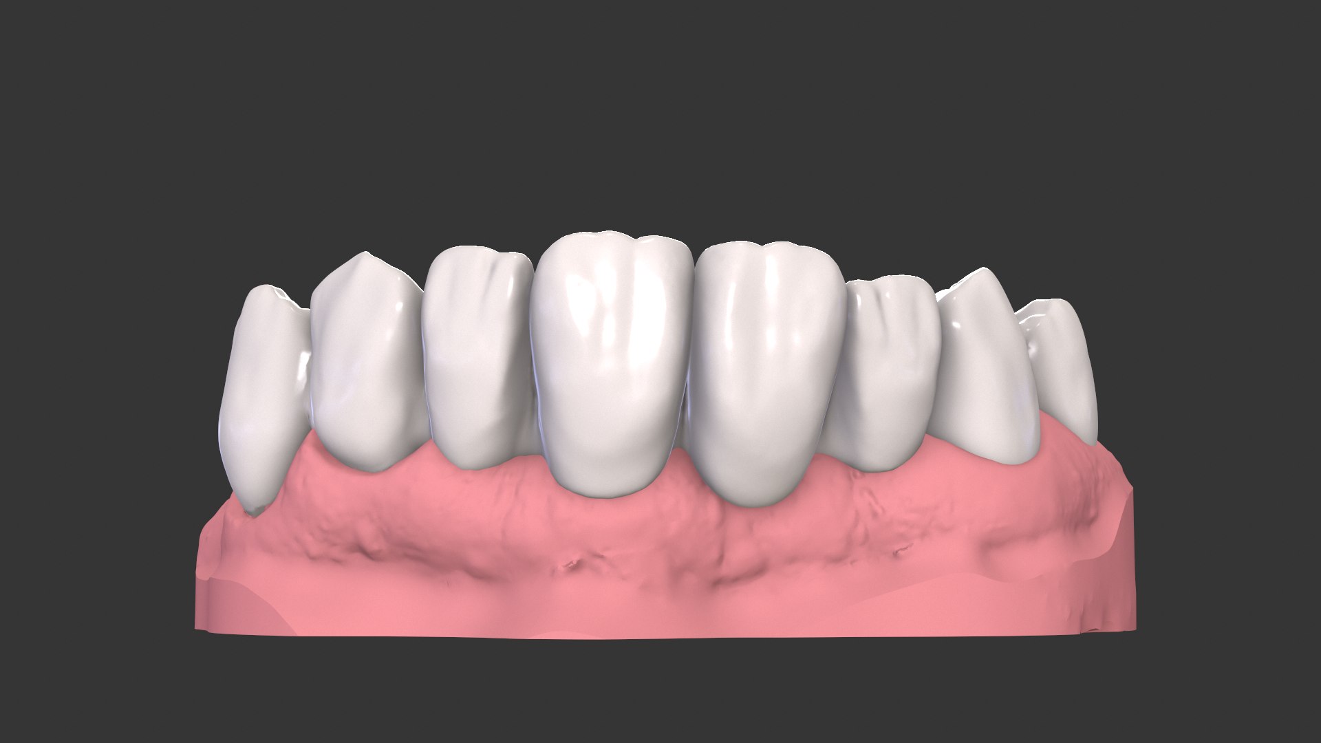 3D Dental Anatomy Bridge Real medical case 3D print model model ...
