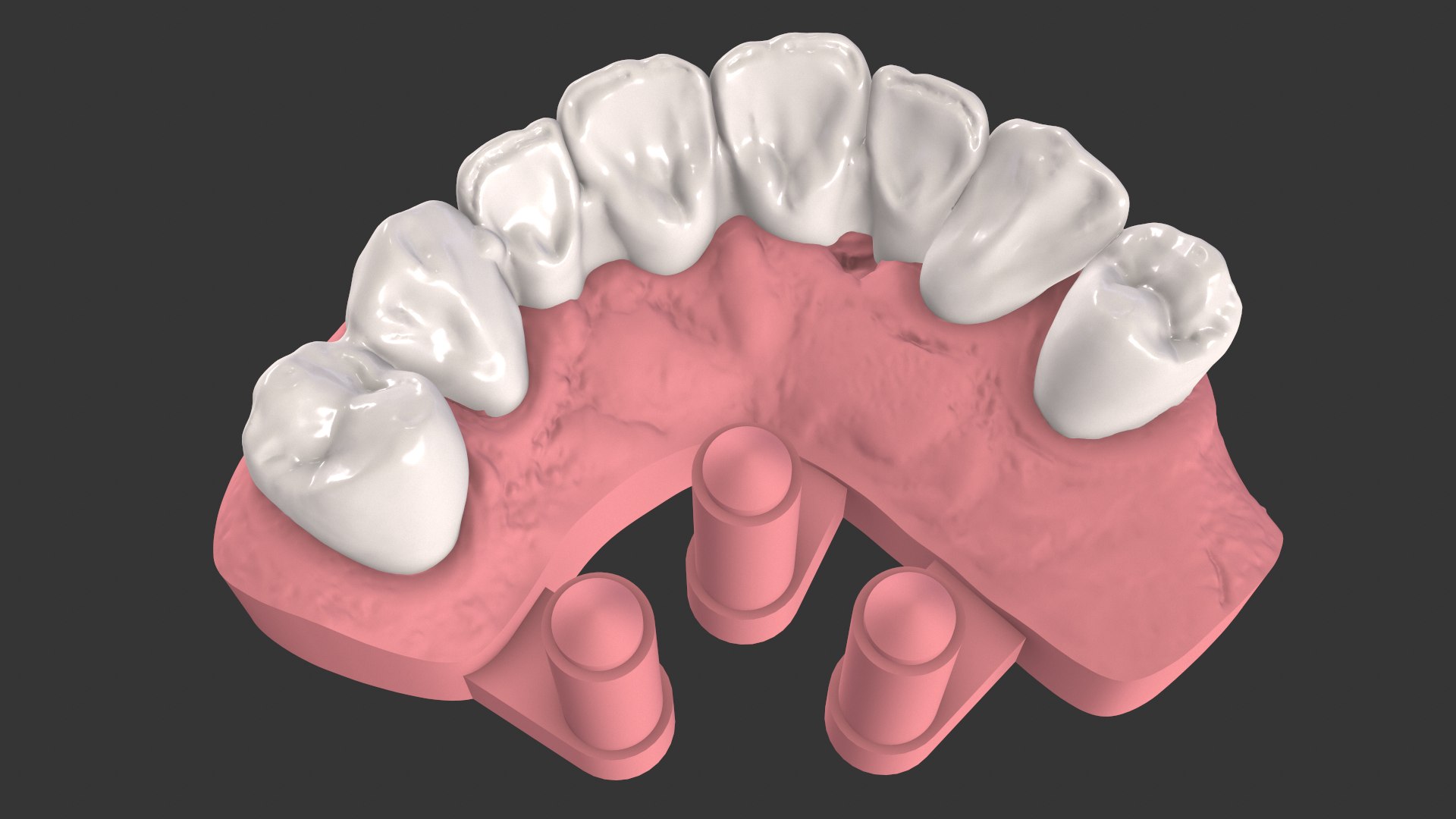 3D Dental Anatomy Bridge Real medical case 3D print model model ...