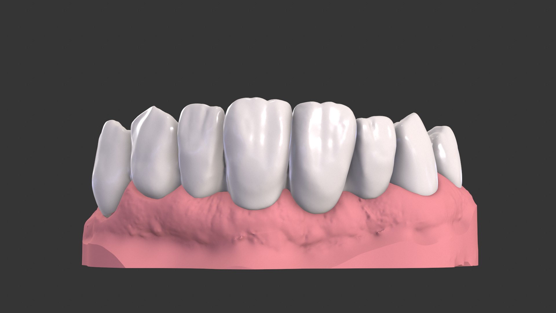 3D Dental Anatomy Bridge Real medical case 3D print model model ...