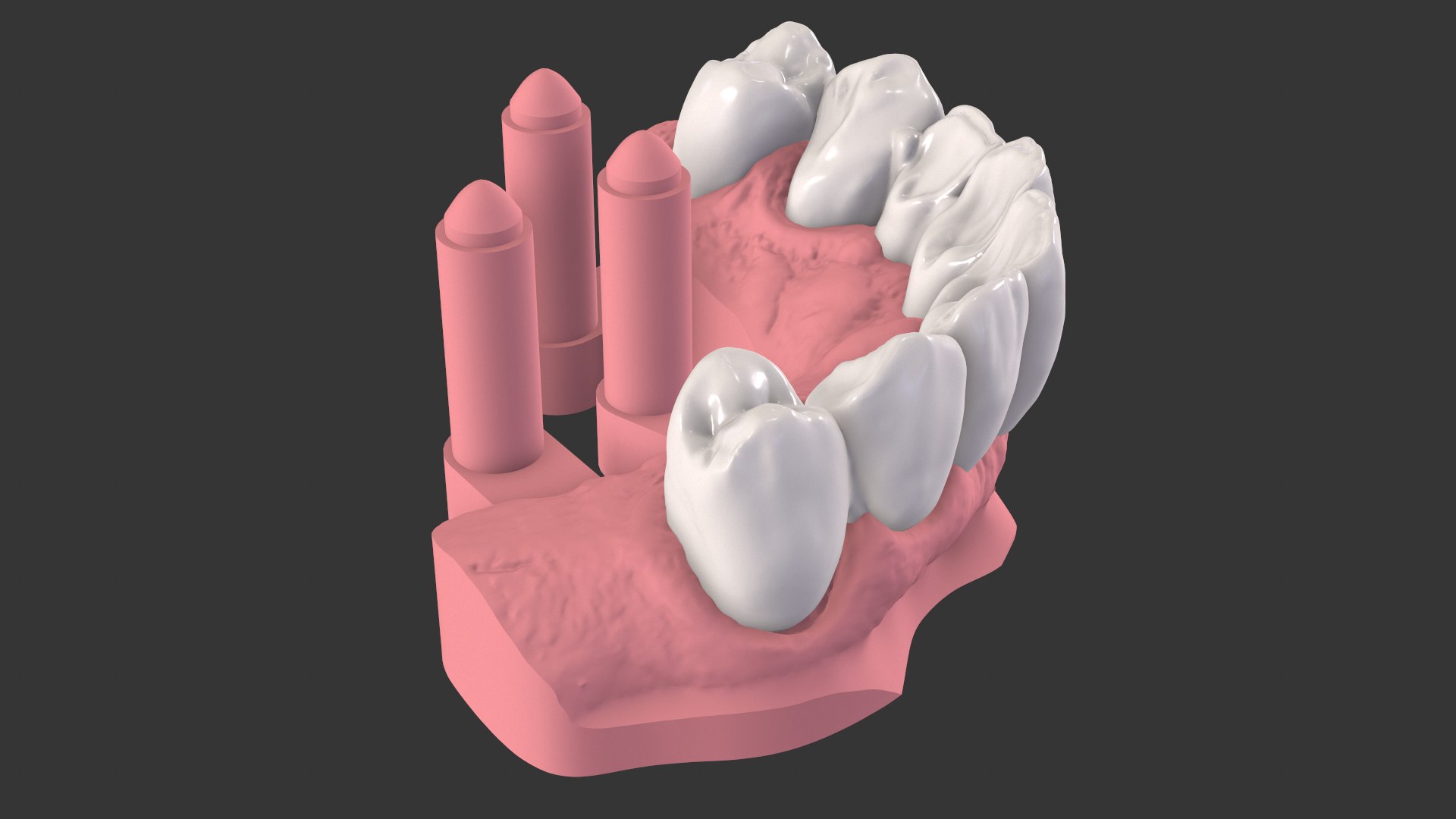 3D Dental Anatomy Bridge Real medical case 3D print model model ...