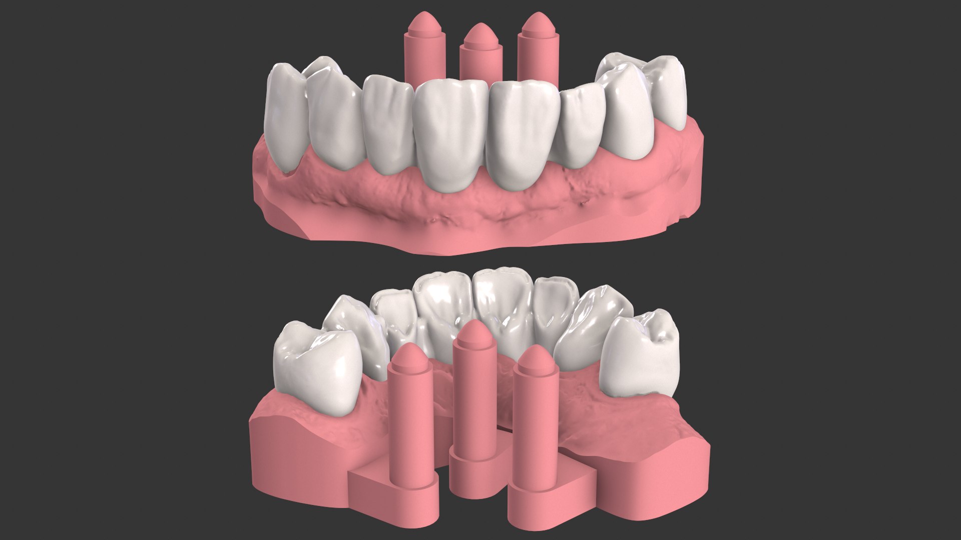 3D Dental Anatomy Bridge Real medical case 3D print model model ...