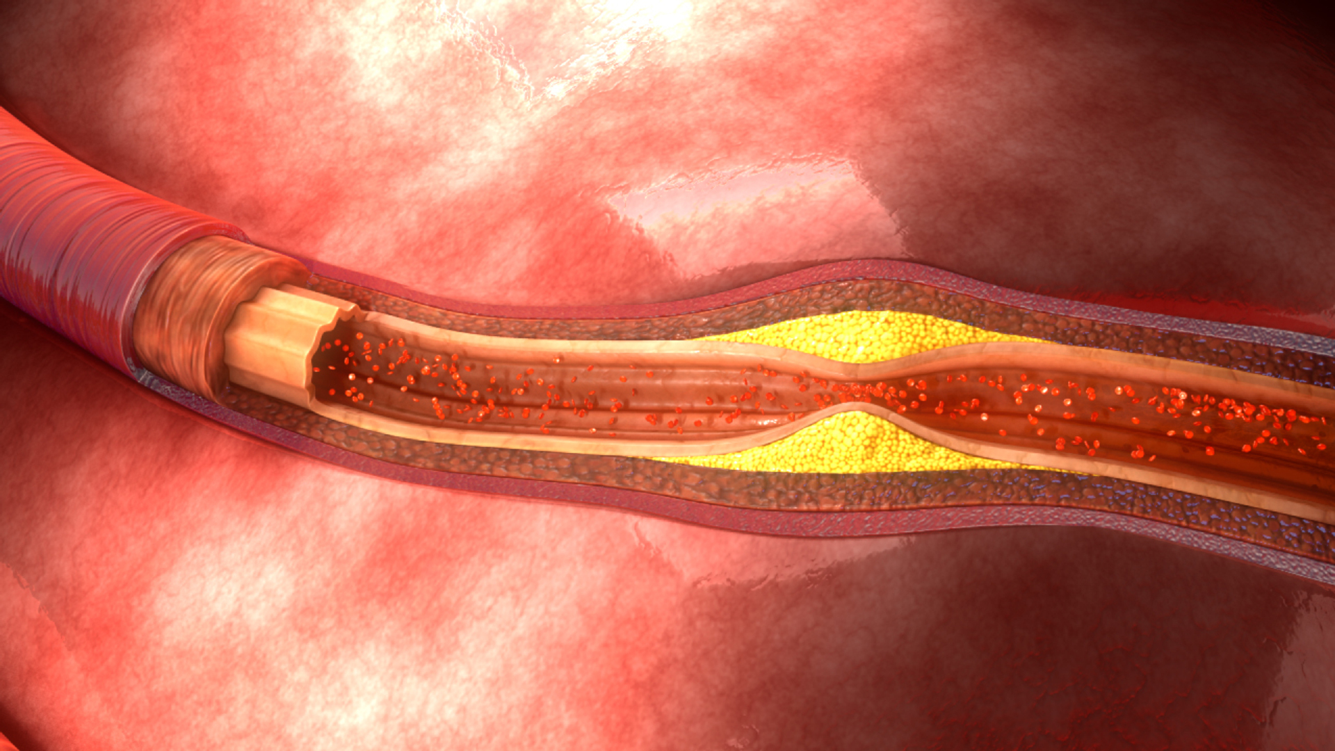 Atherosclerosis 3d Model