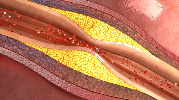 3d artery dissection animation model