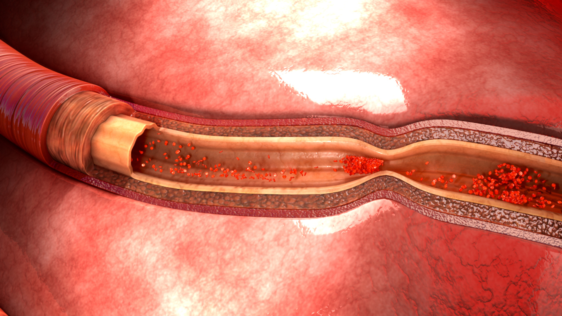 3d Coronary Artery Spasm Model