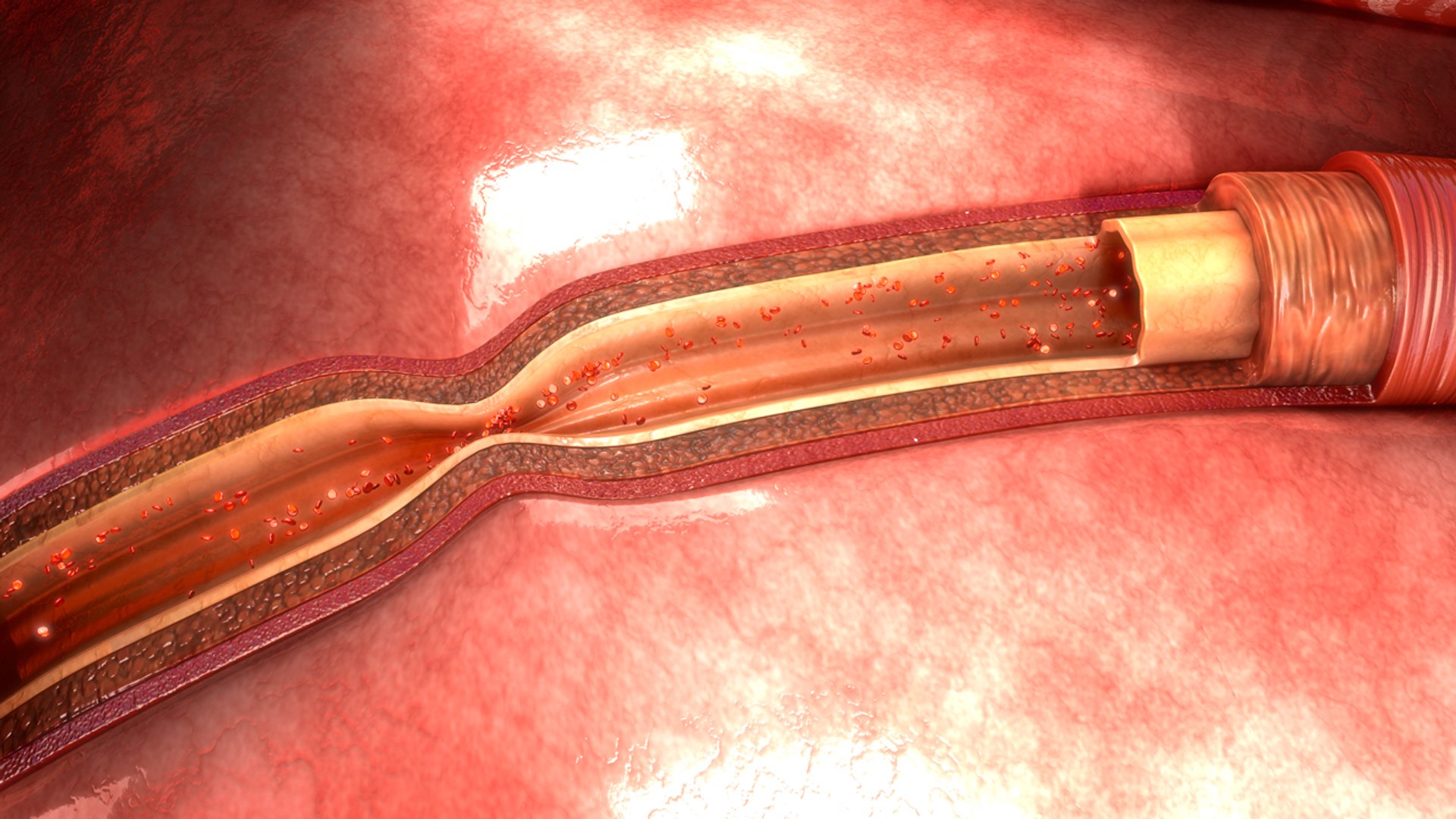 3d Coronary Artery Spasm Model