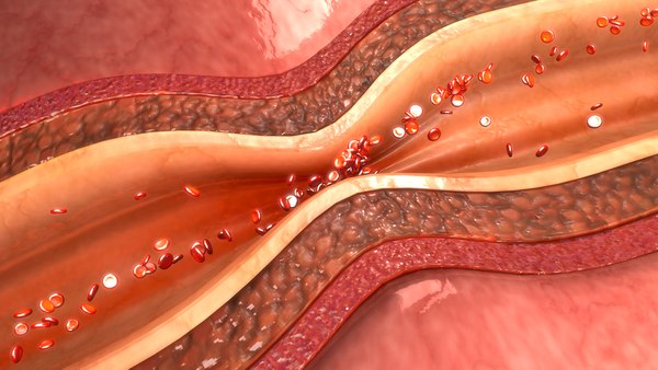 3d coronary artery spasm model
