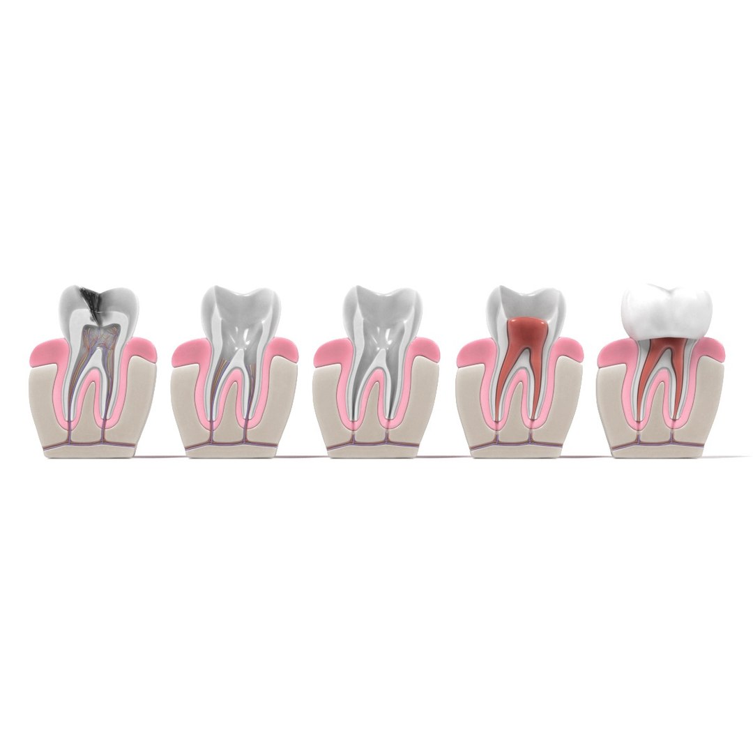 3d Root Canal Procedure