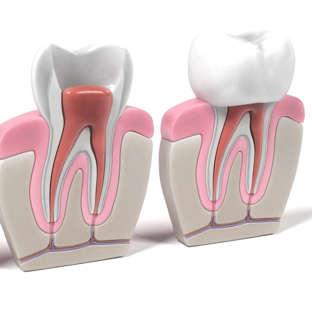 3d Root Canal Procedure