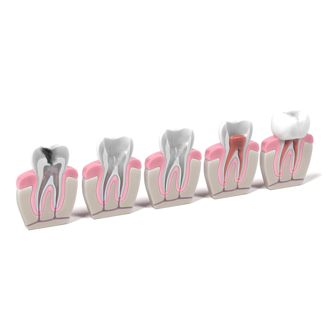 3d Root Canal Procedure