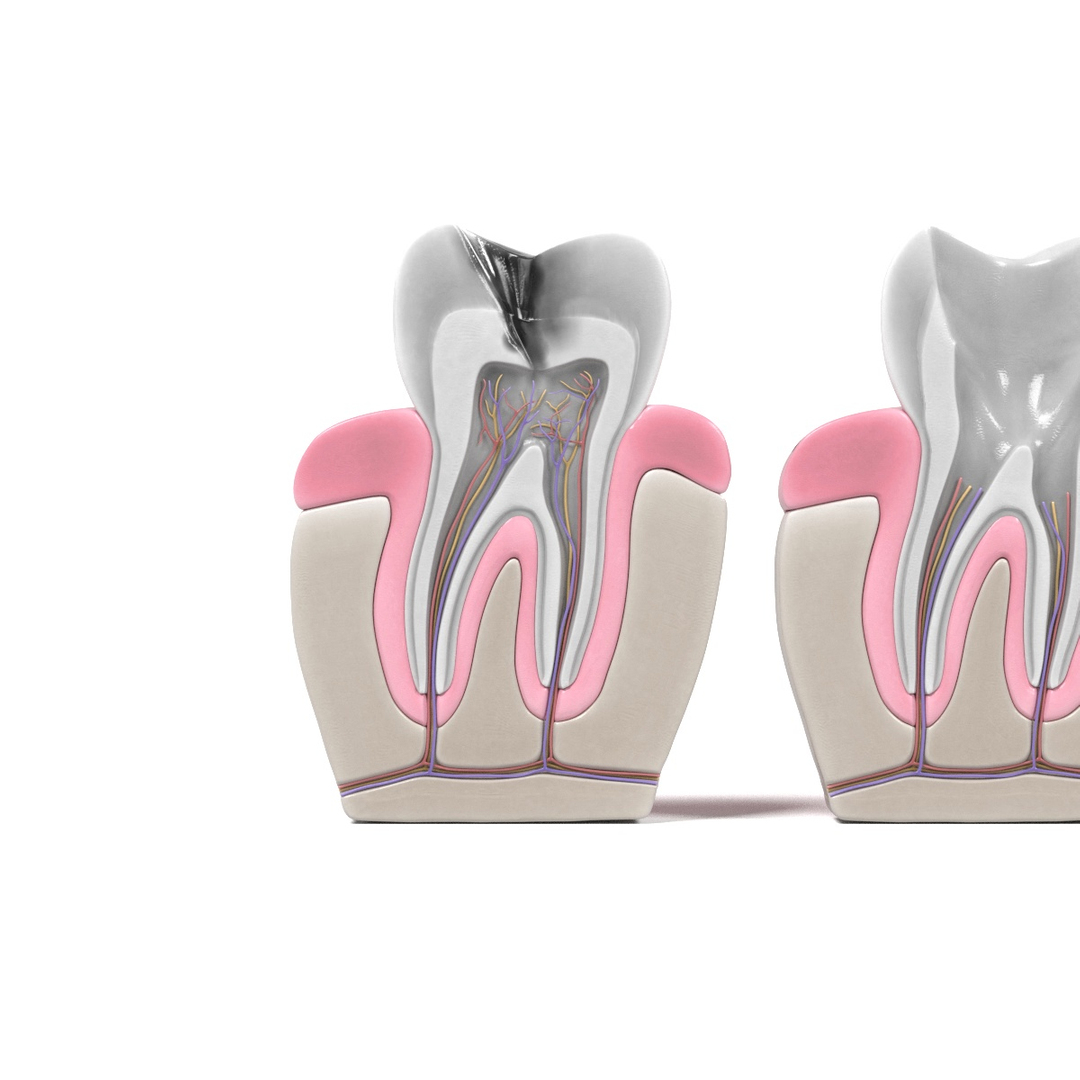 3d Root Canal Procedure