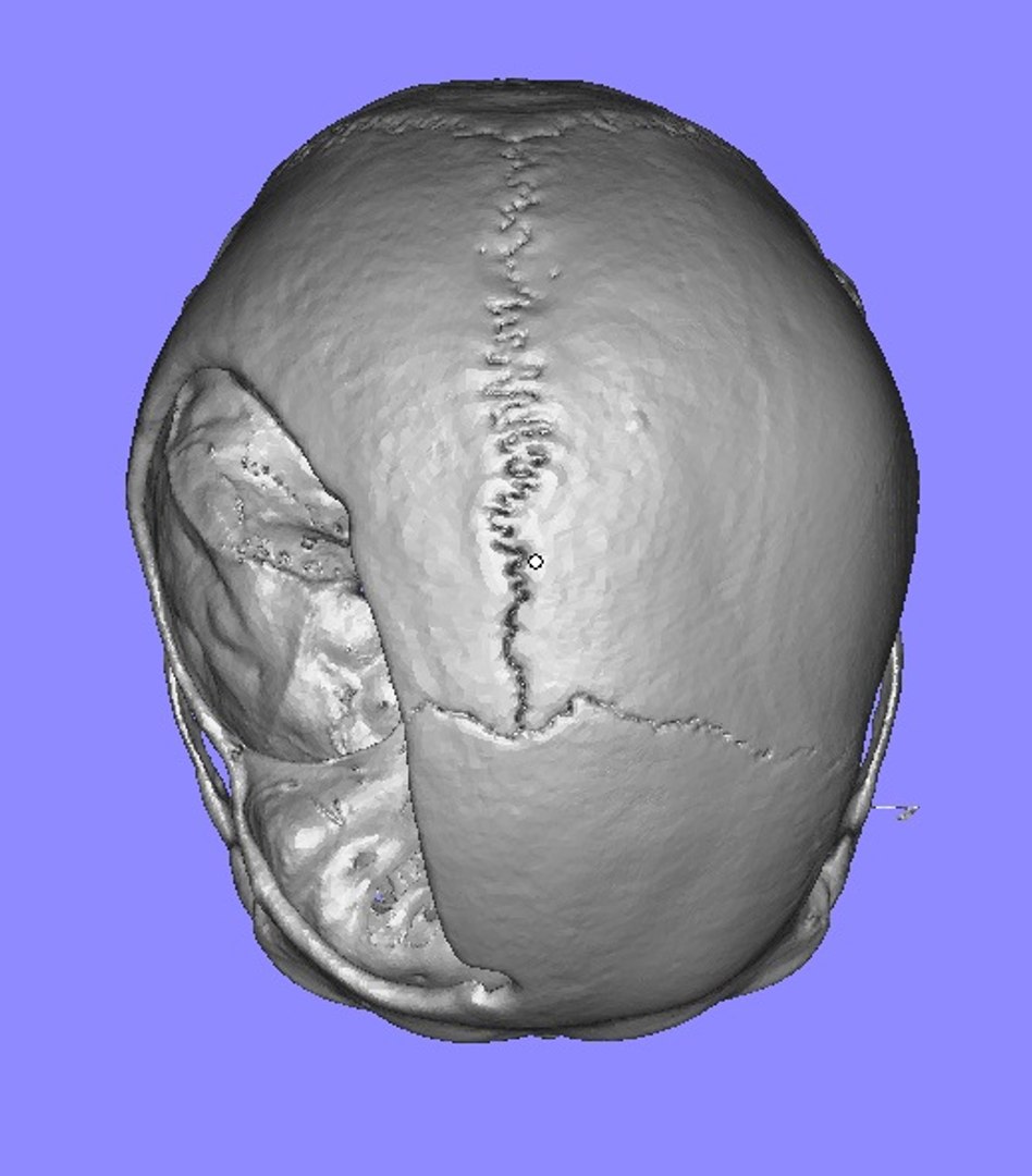 3d Skull Defect Ct