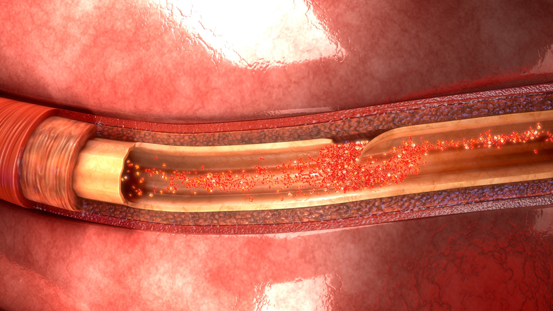 3d Artery Dissection Model