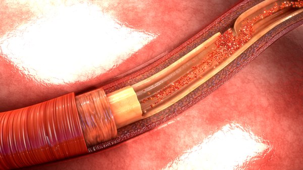 3d artery dissection model