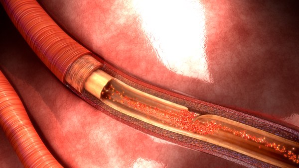 3d artery dissection model