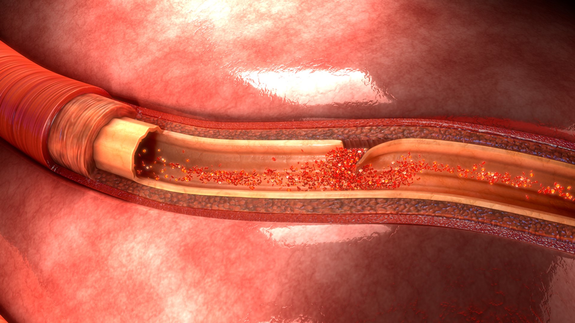 3d Artery Dissection Model