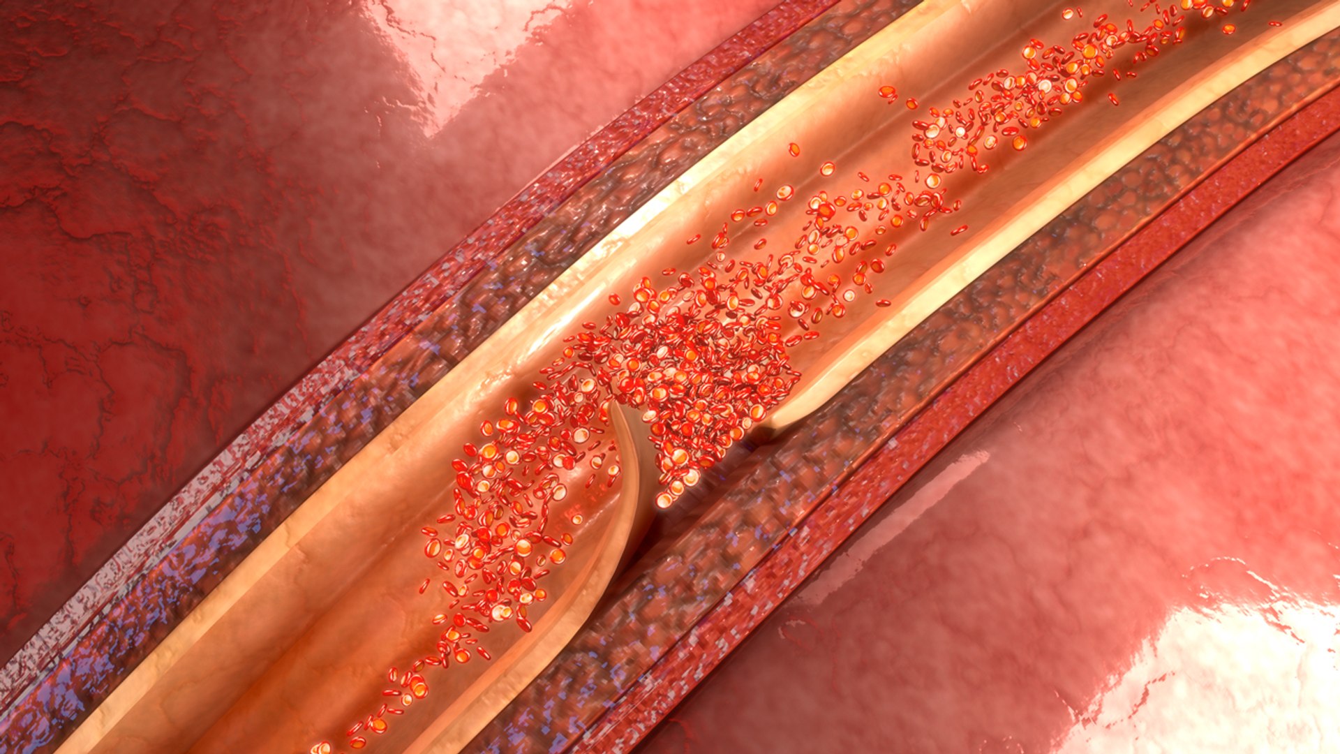 3d Artery Dissection Model