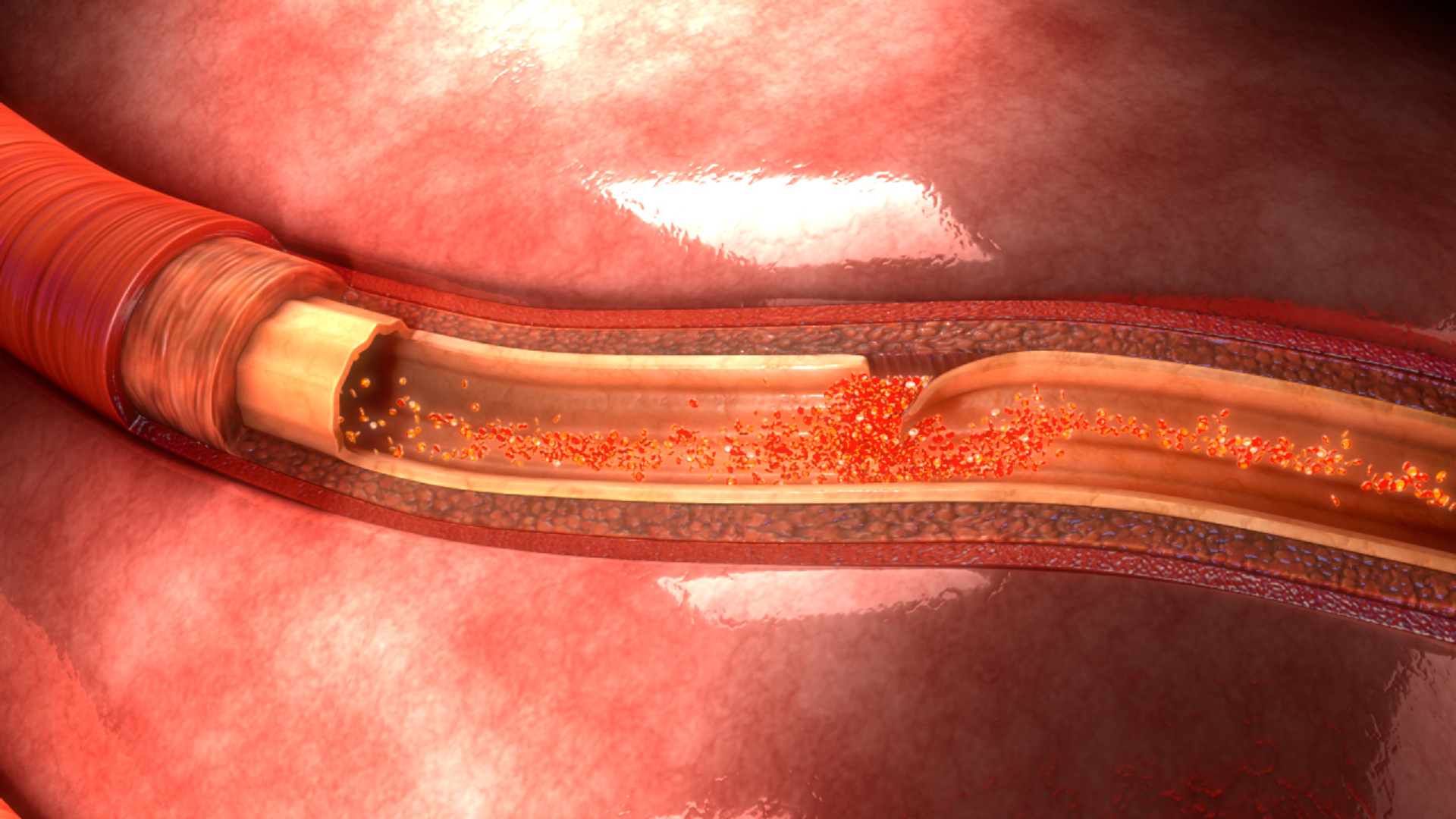 3d Artery Dissection Model