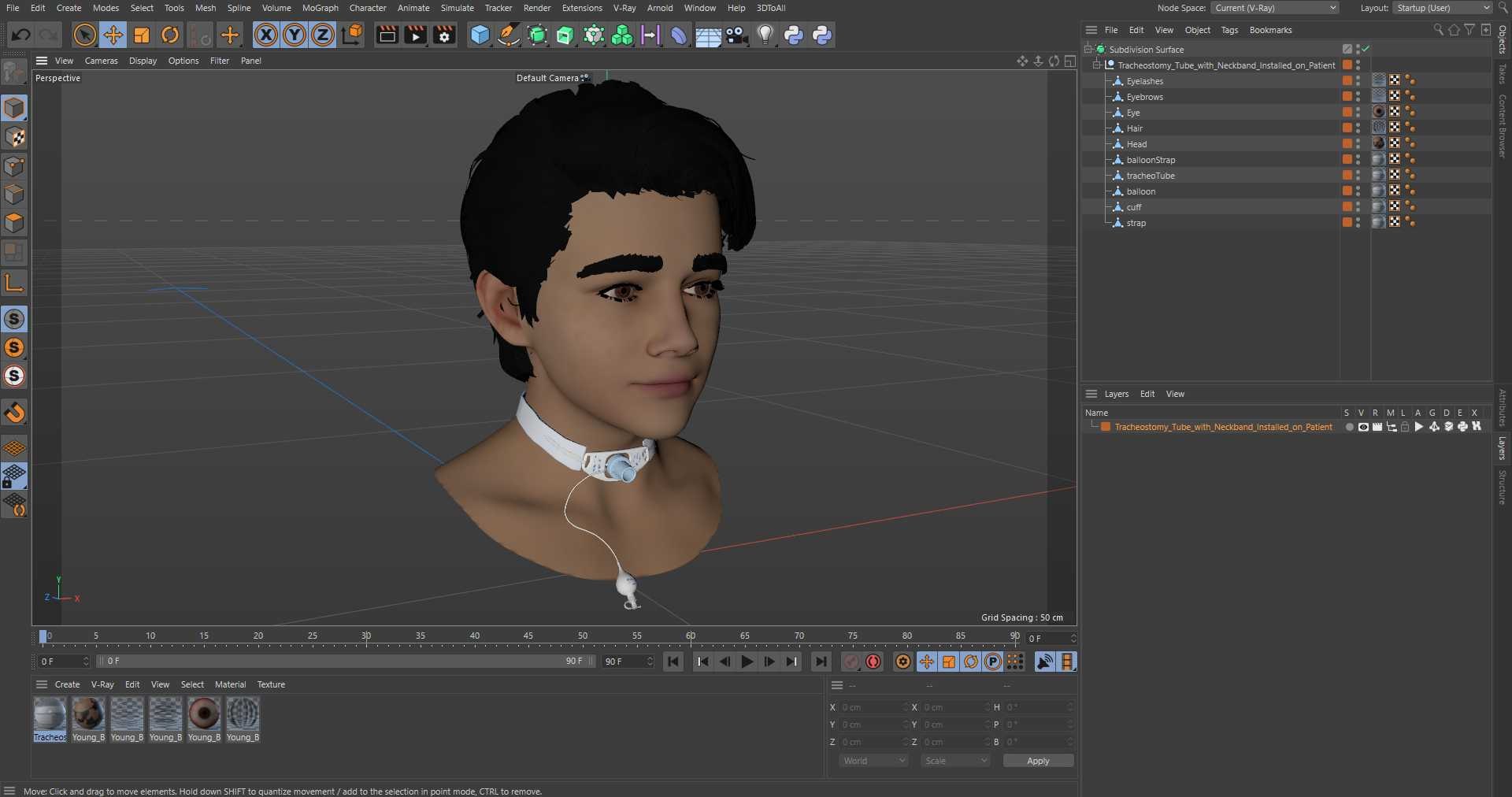 3D Tracheostomy Tube With Neckband Installed On Patient Model ...