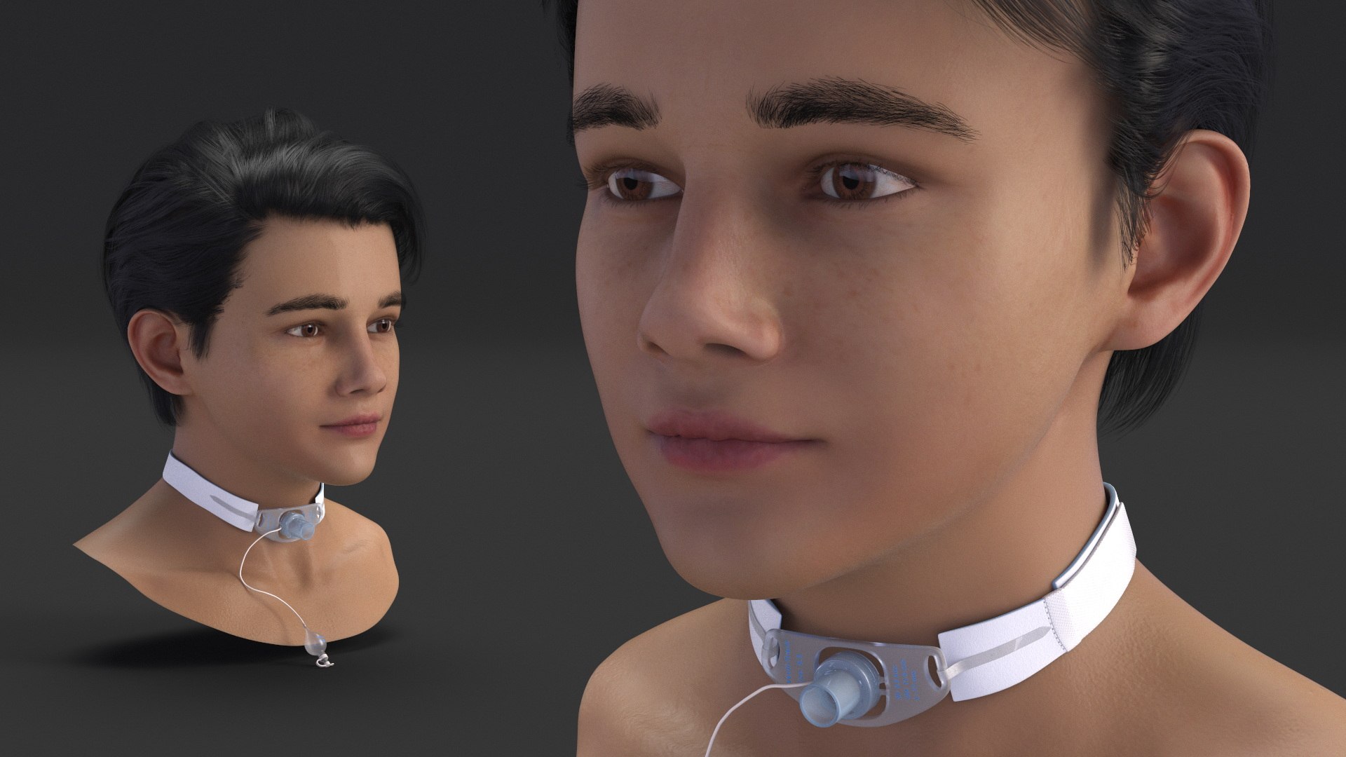 3D Tracheostomy Tube With Neckband Installed On Patient Model ...