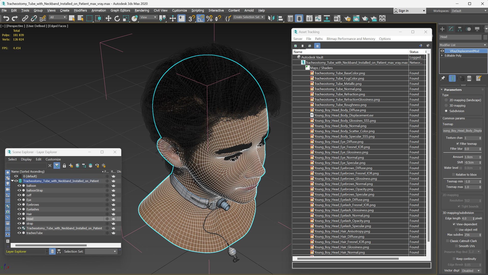 3D Tracheostomy Tube With Neckband Installed On Patient Model ...