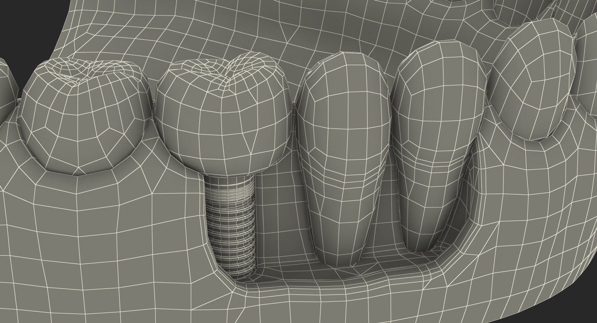Lower teeth medical dental 3D model - TurboSquid 1428835