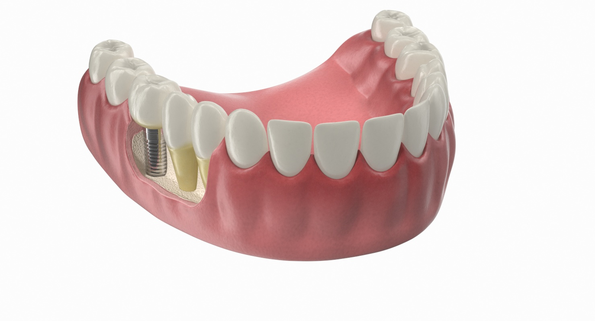 Lower Teeth Medical Dental 3D Model - TurboSquid 1428835