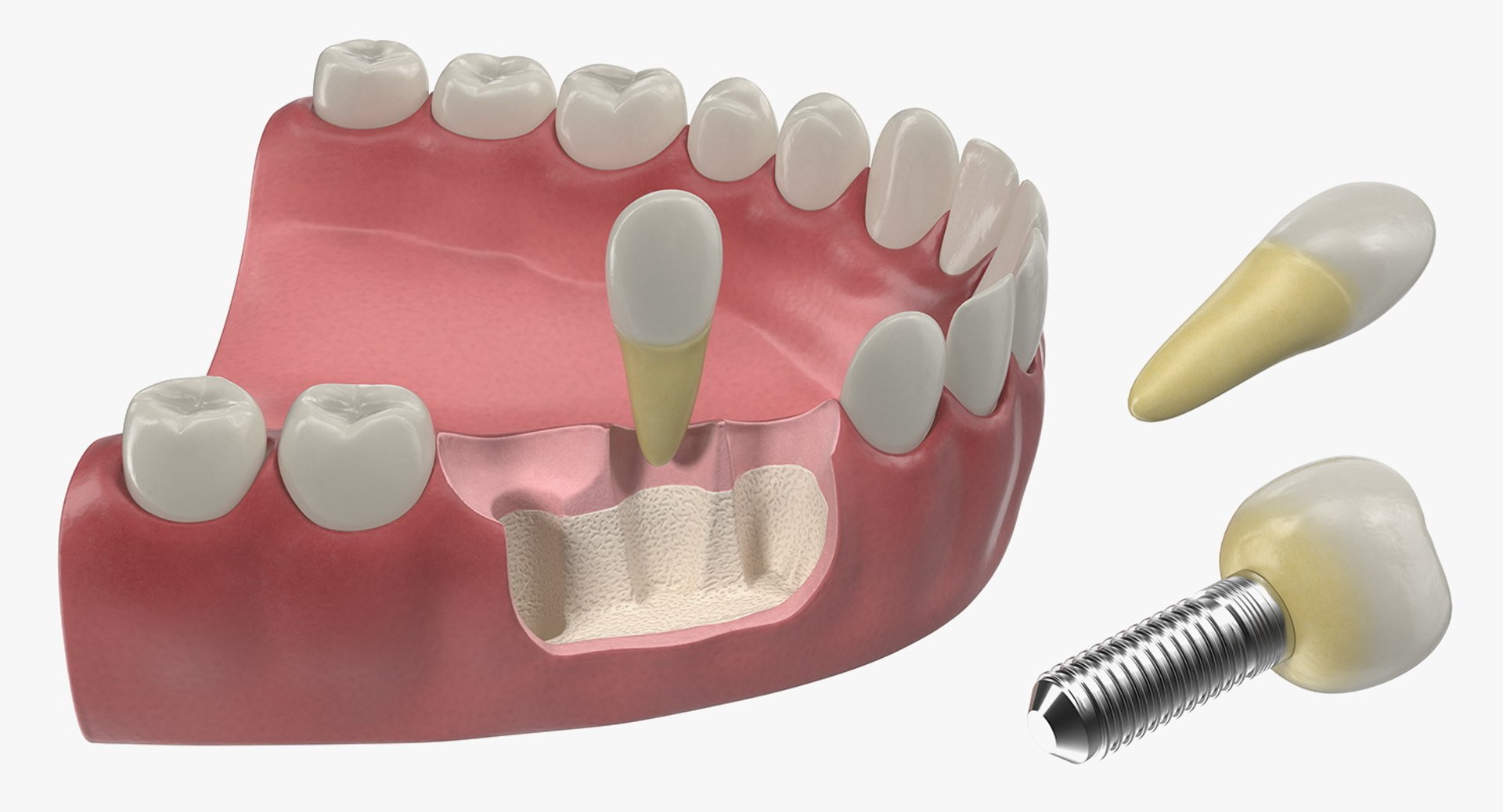 Lower teeth medical dental 3D model - TurboSquid 1428835