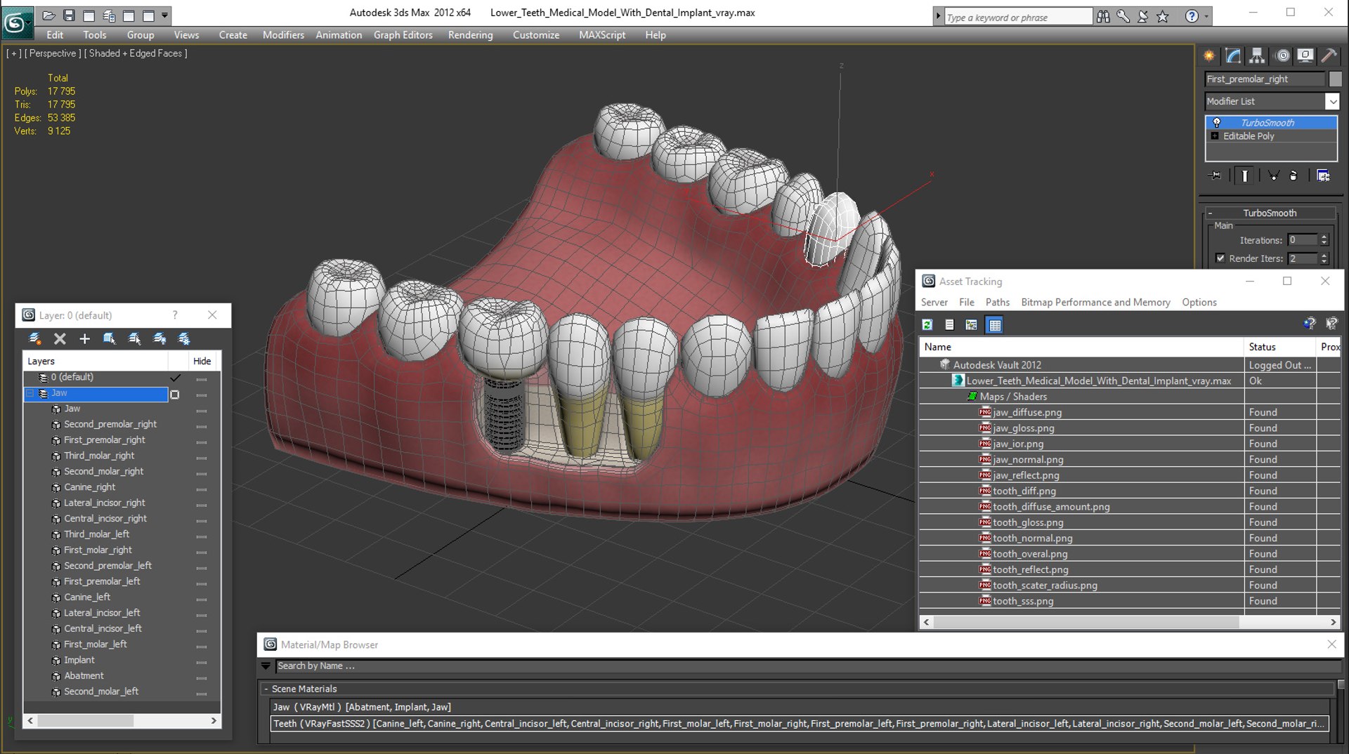 Lower teeth medical dental 3D model - TurboSquid 1428835