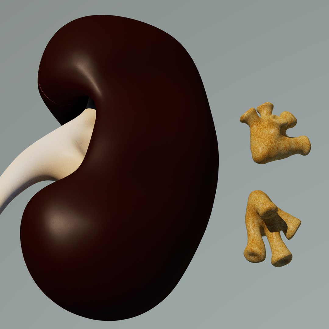Kidney Stones 3D Model - TurboSquid 2026711