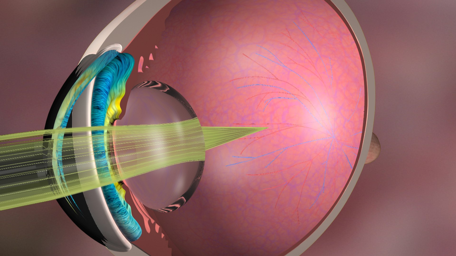 Medical Illustration Myopia 3d Max