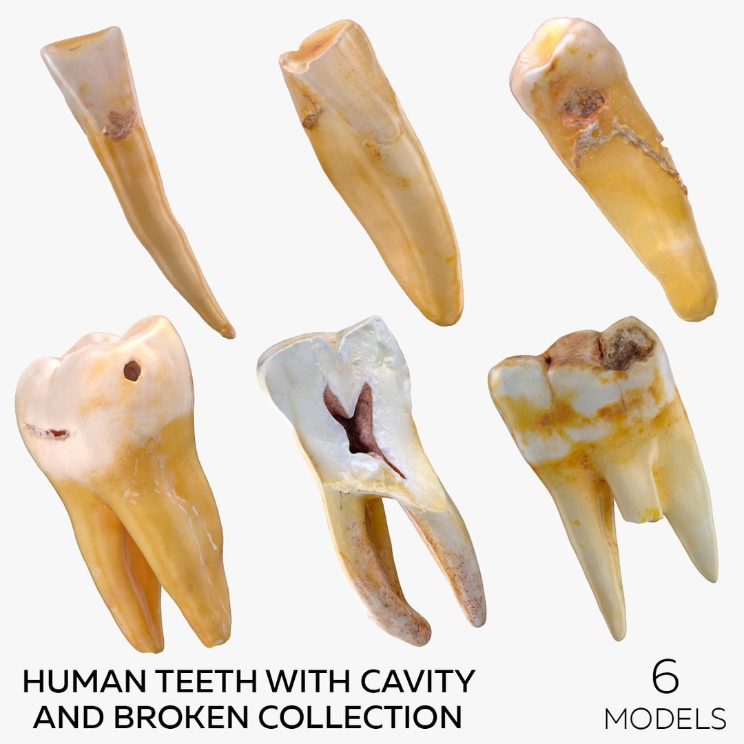Human Teeth with Cavity and Broken Collection - 6 models 3D ...