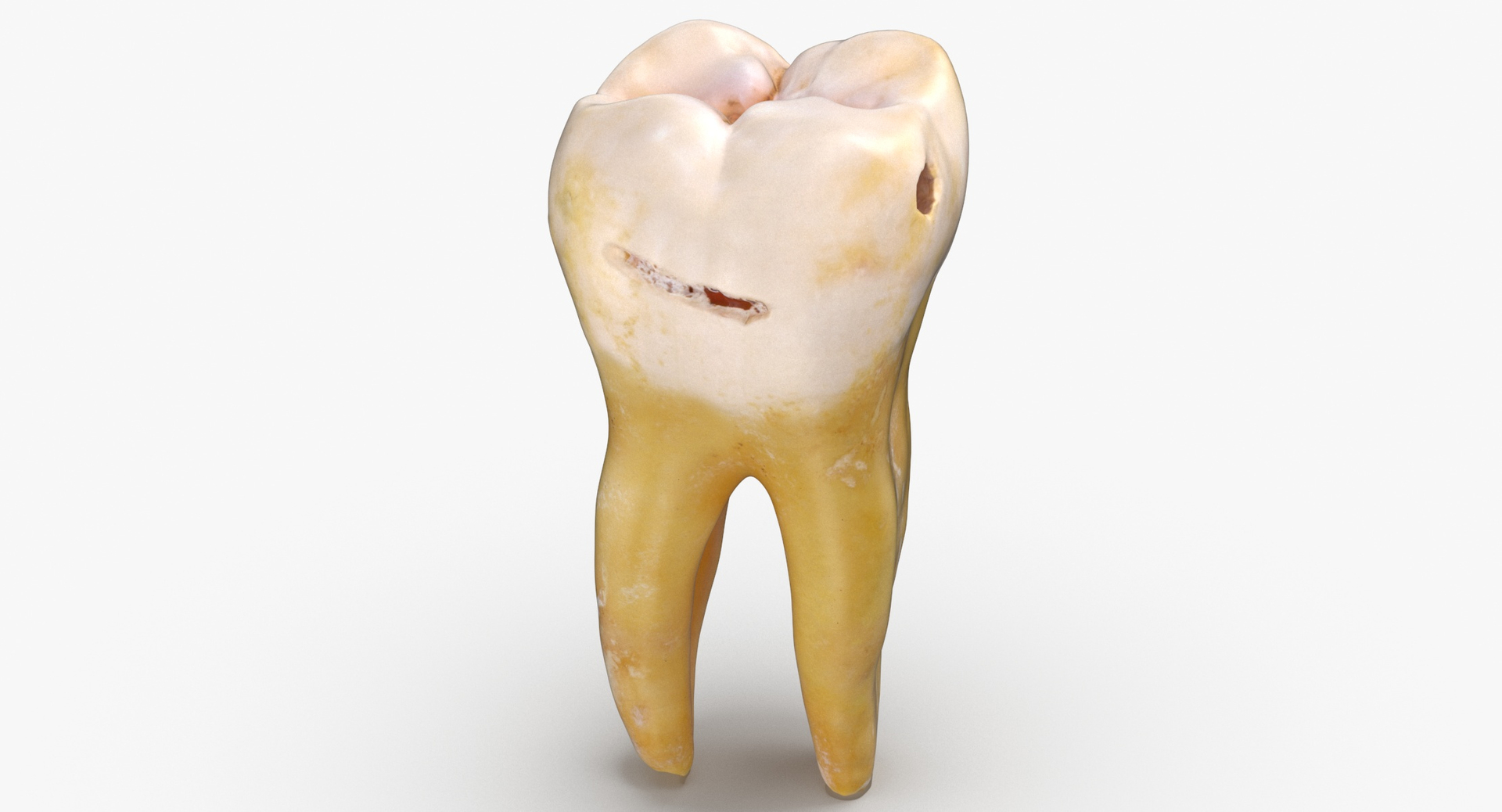 Human Teeth with Cavity and Broken Collection - 6 models 3D ...