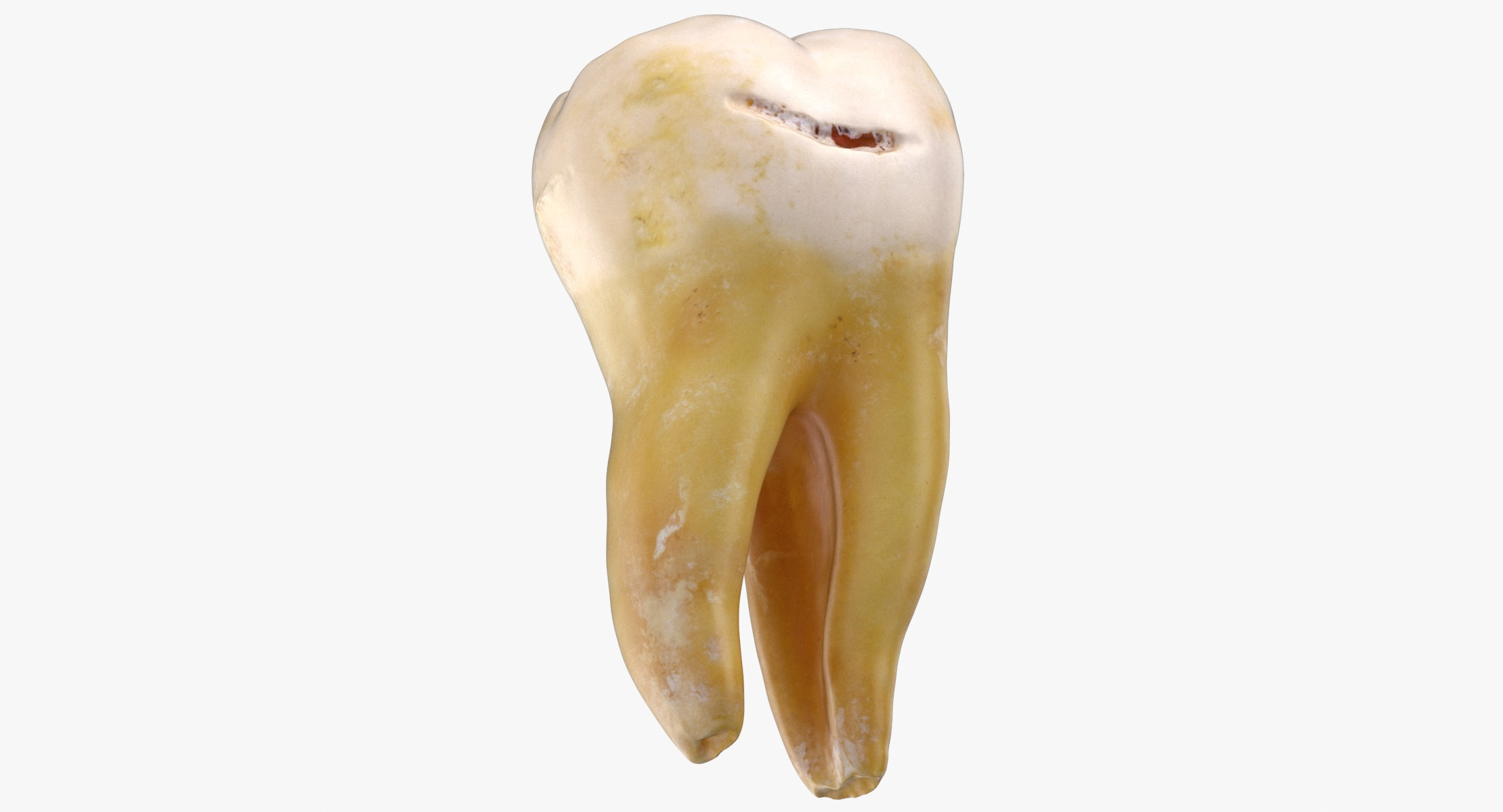 Human Teeth with Cavity and Broken Collection - 6 models 3D ...