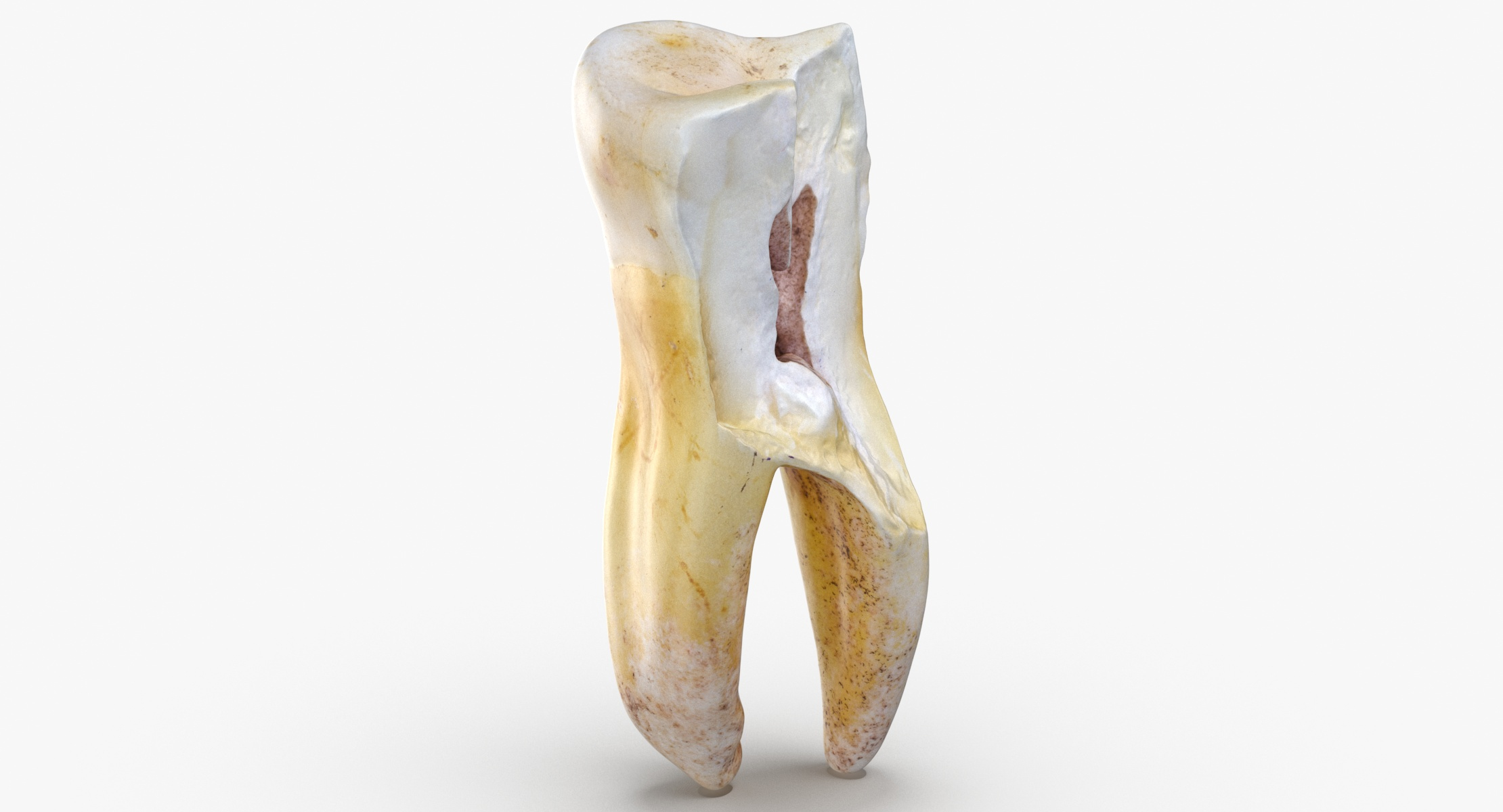 Human Teeth with Cavity and Broken Collection - 6 models 3D ...