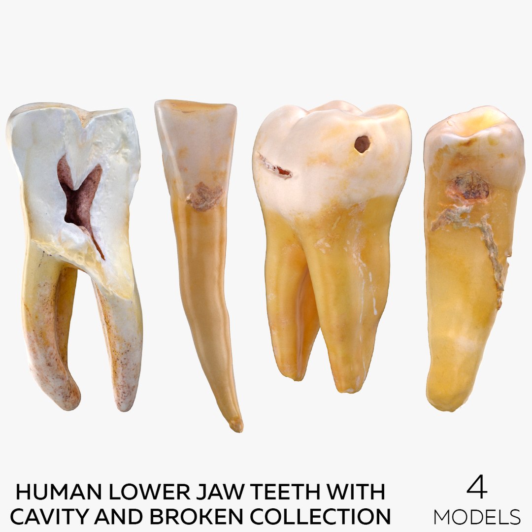 Dentes humanos da mandíbula inferior com cárie e coleção quebrada - 4 ...