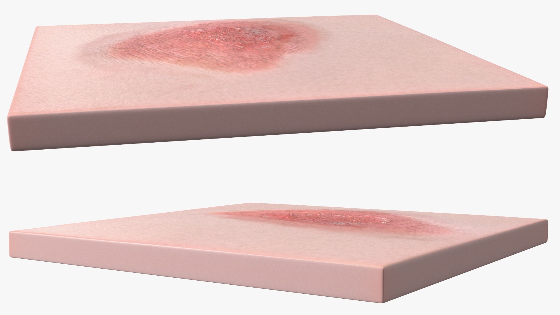 3D Burned Skin Model - TurboSquid 2159253