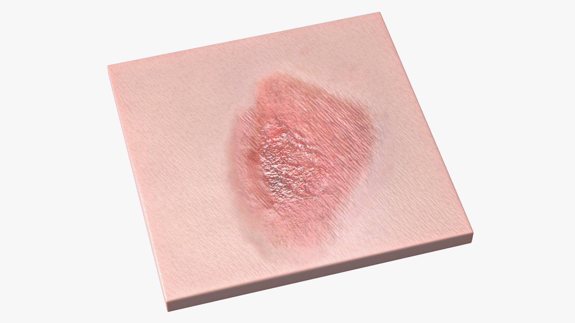 3D Burned Skin model - TurboSquid 2159253